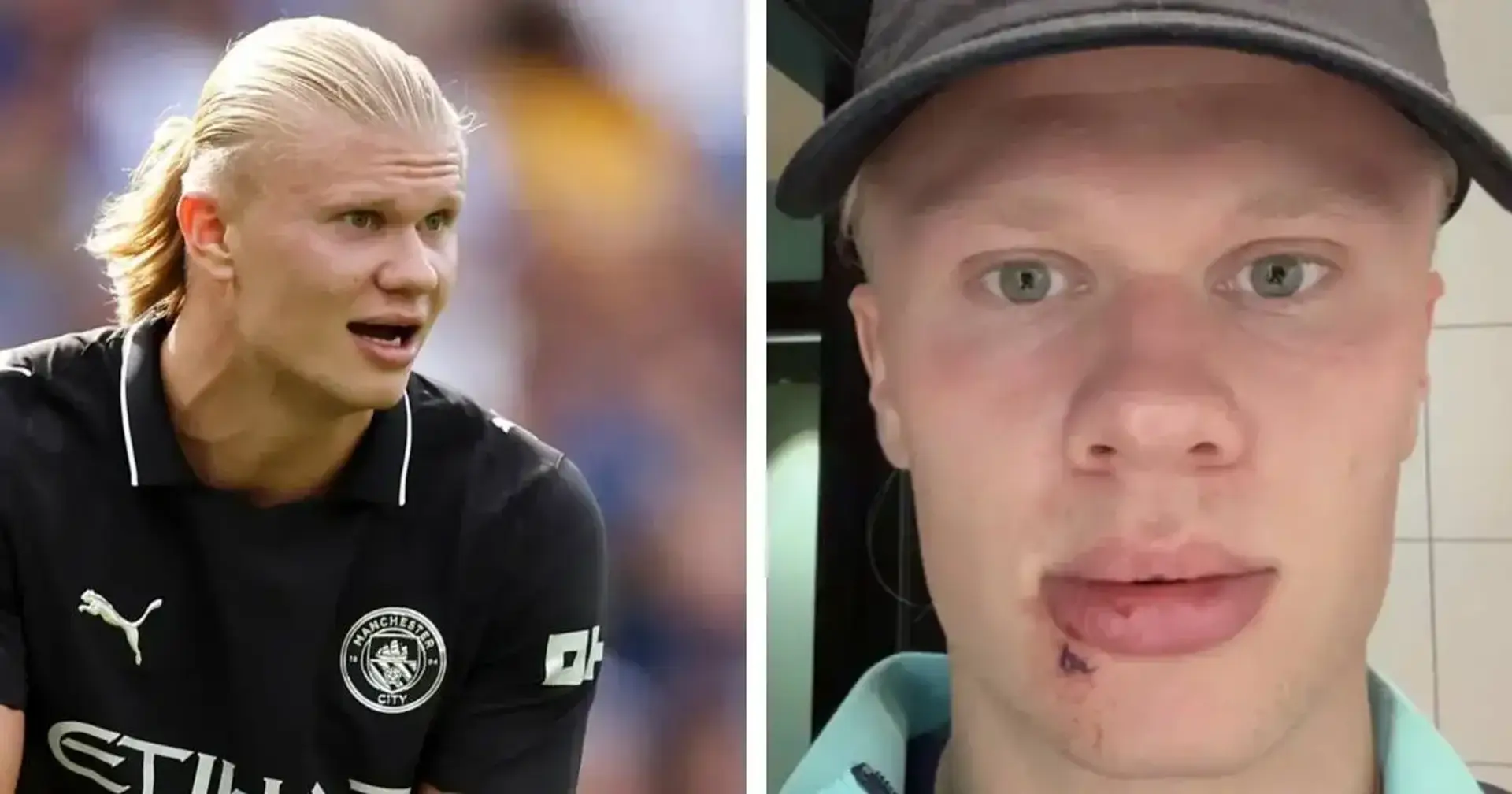 "3 Stiche": Erling Haaland zeigt Fotos seiner Gesichtsverletzung nach ...