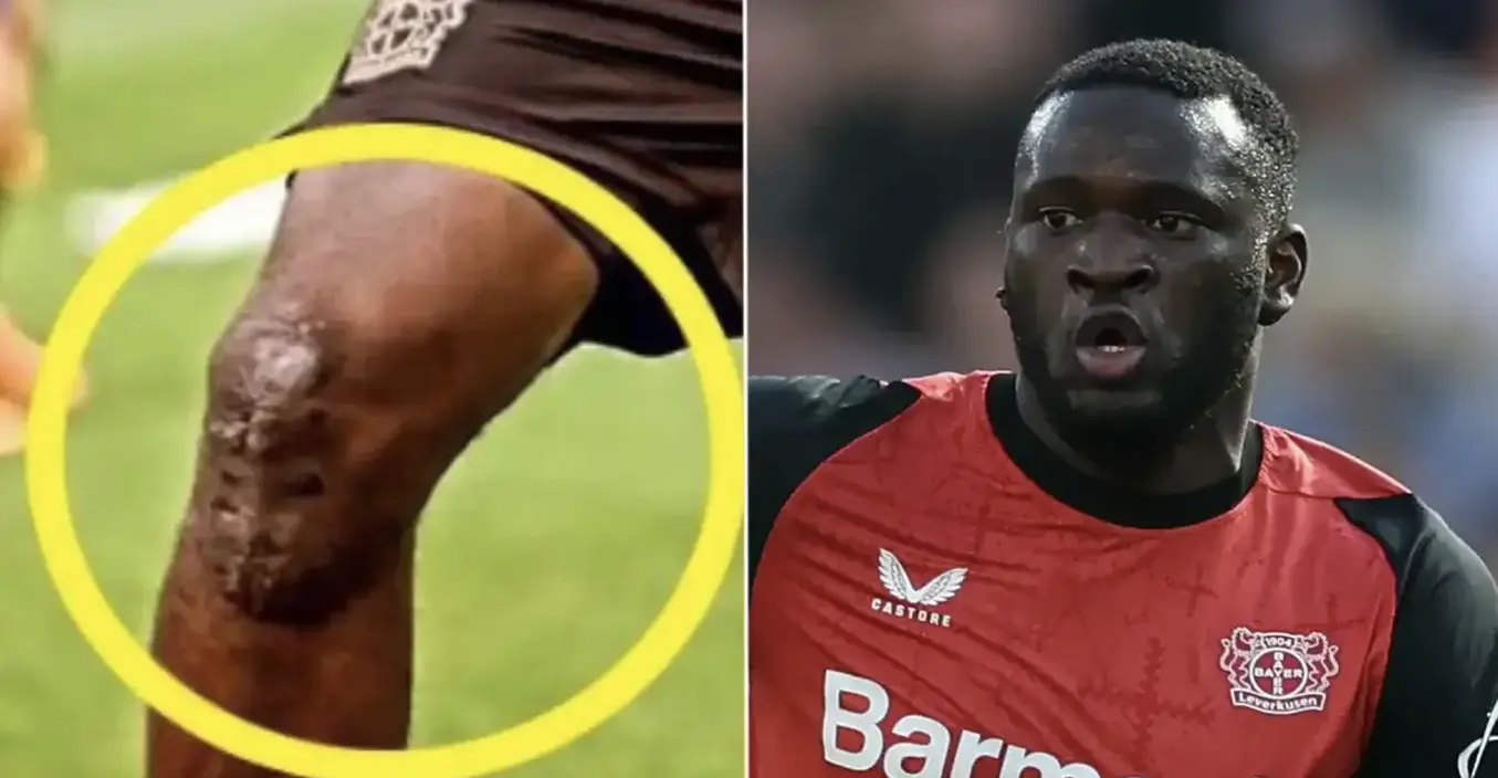 Photo of Boniface’s knee goes viral, showing why his deal with Milan ...